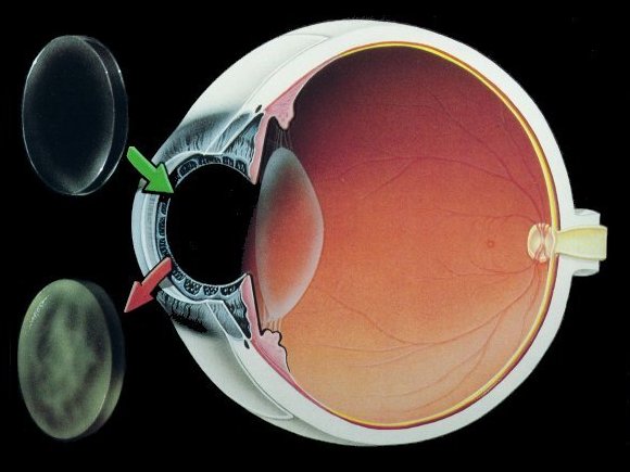 Corneal Transplant Eye Surgery